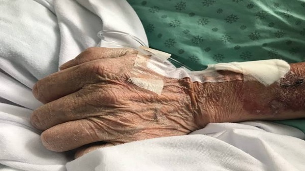 3M Unveils High-tack Silicone Adhesive for People with Fragile Skin