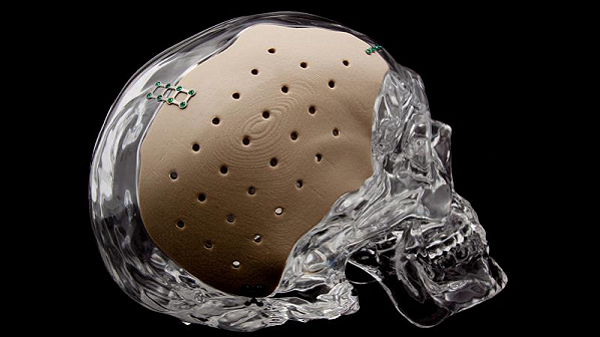 OPM Collaborates with Jajal Medical for 3D Printed Orthopedic Polymer ...