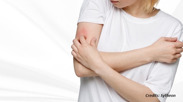 Sytheon Unveils Its New Turnkey Product for Treating Atopic Dermatitis